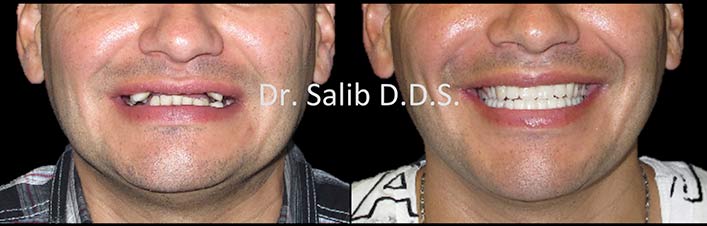Dr. Salib Before and After Photo - OC Oral Surgery & Dental ImplantsOC ...